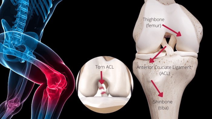 ACL Injury Prevention Treatment And Recovery Total Body Physio ACL Injury Prevention Treatment And Recovery Total Body Physio
